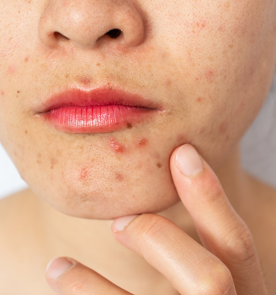 10 mitos e verdades sobre espinha - Beleza na Web