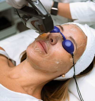 Laser Etherea: para que serve o procedimento e o que faz - Beleza na Web